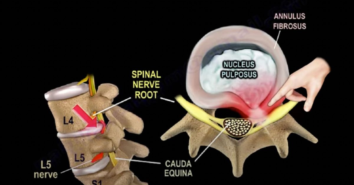 MedShr Learning | Neurological Examination For A Herniated Disc