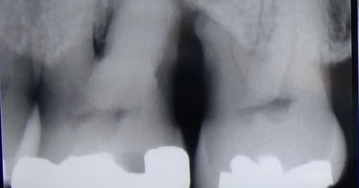 MedShr Learning | Root Canal on Maxillary 1st & 2nd Molars - Dental ...