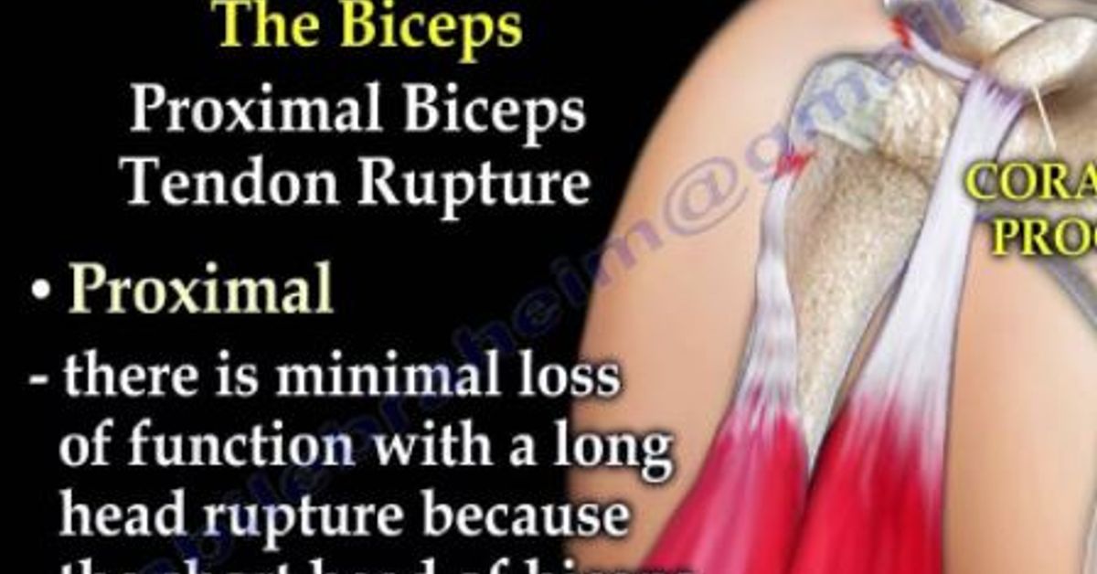 MedShr Learning | Biceps Tendon Subluxation Or Dislocation: how to ...