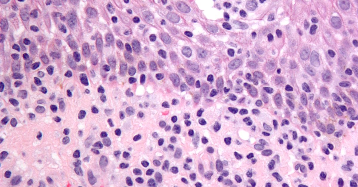 MedShr Learning | Cutaneous T-Cell Lymphomas (CTCL)