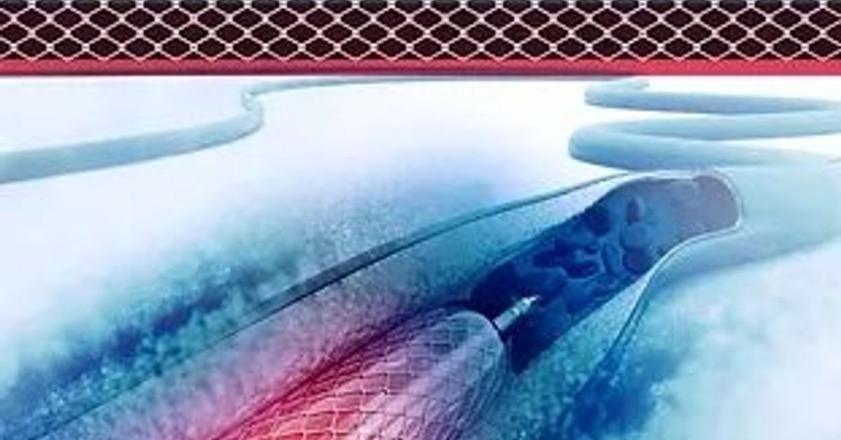 Manual of Percutaneous Coronary Interventions (PCI) - Part A: The Steps ...