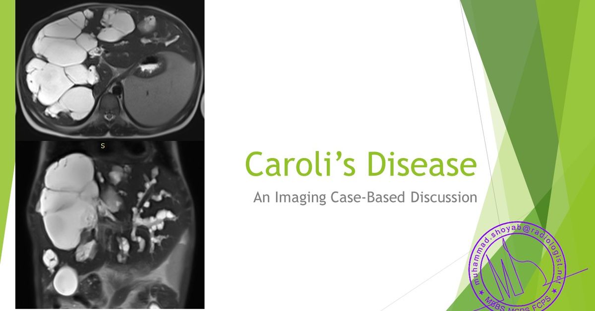 MedShr Learning | Caroli's Disease — A Patient Case & Brief Discussion