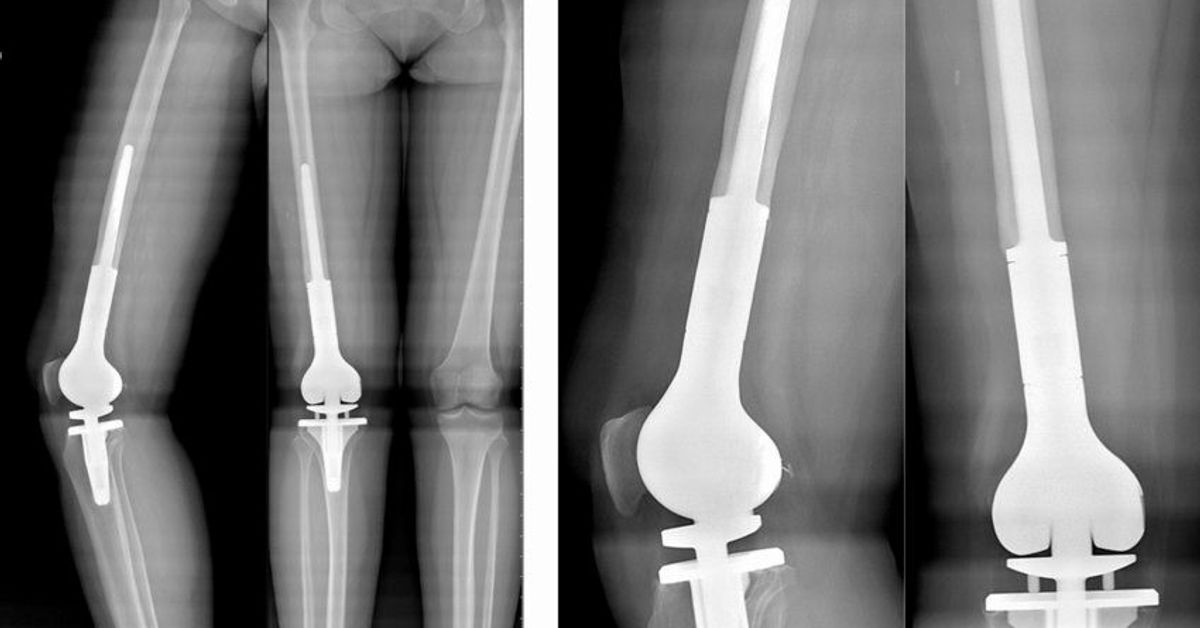 MedShr Learning | 2022/23 Talk: How to do a Distal Femoral Replacement