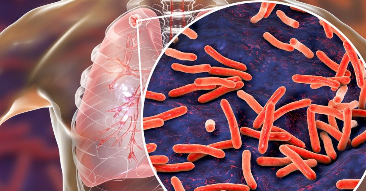 MedShr Learning | A Concise Guide to Tuberculosis (TB)