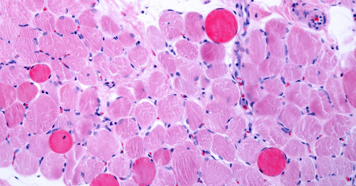 Duchenne Muscular Dystrophy Education Supported by Pfizer